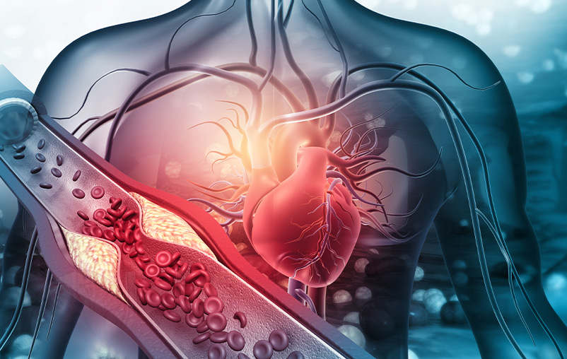 Preventing Coronary Artery Disease | HealthFocus SA | University Health
