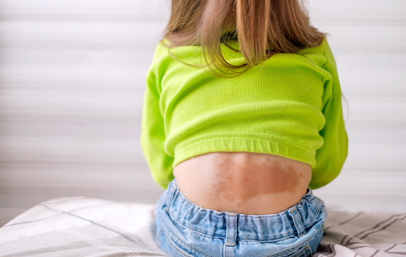 Neurofibromatosis Awareness Day | HealthFocus SA | University Health